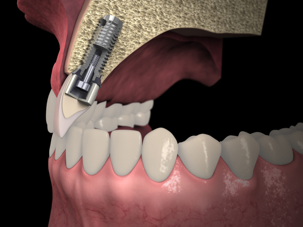 Todo lo que debes saber sobre el seno maxilar, la elevación y los quistes