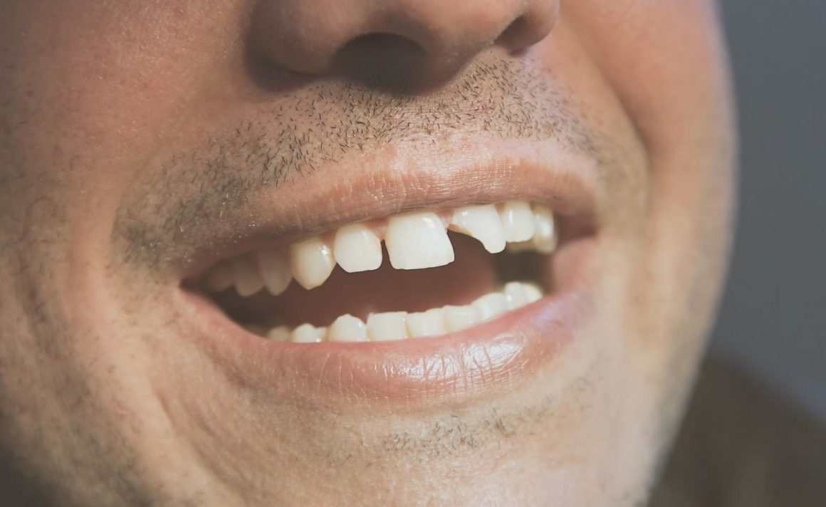 Dientes rotos. Cómo solucionar este problema de forma profesional