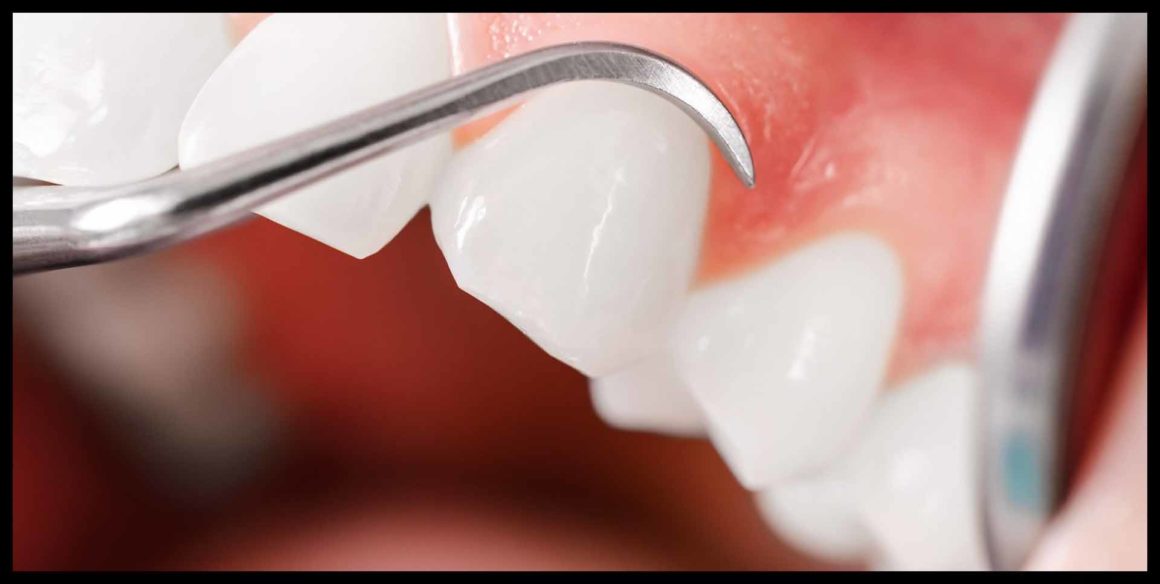 ¿Qué es una periodoncia y cómo se trata este problema?