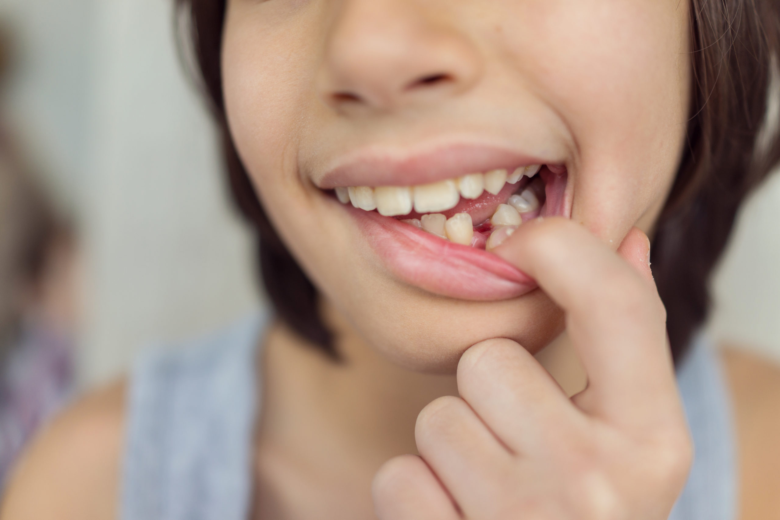 Avulsión dental, ¿qué es y cómo se trata? | Servibucal