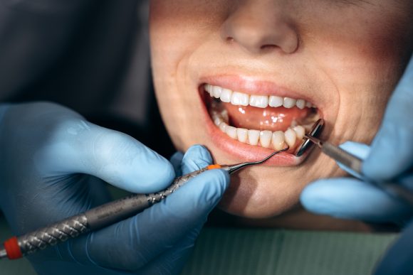 Gingivectomía y gingivoplastia, ¿qué son y cuándo realizarlo?